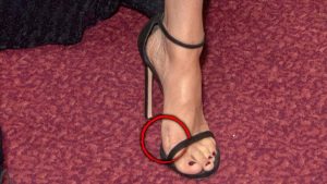 PHOTOS: What's wrong with Meghan Markle's feet?
