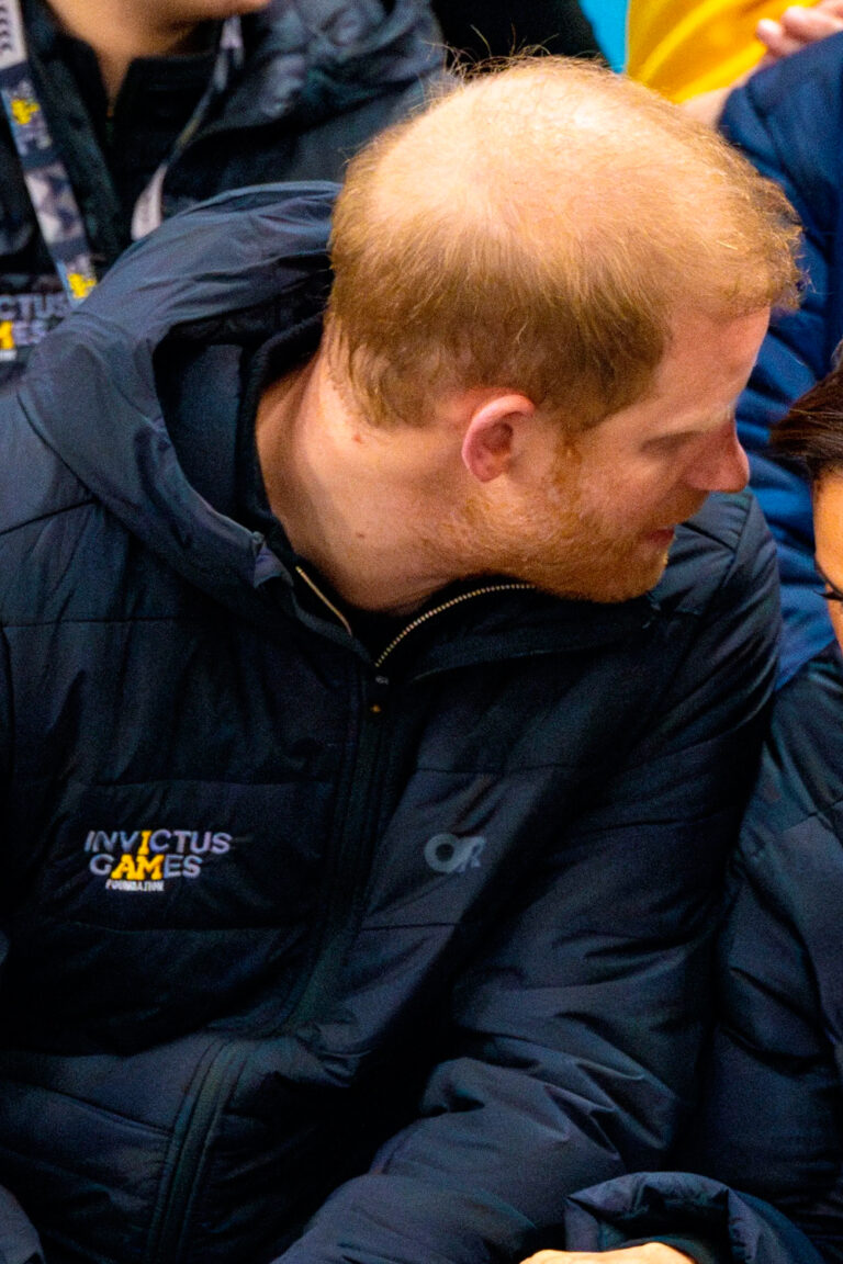 Prince Harry Balding: Expert Urges Him to Embrace It